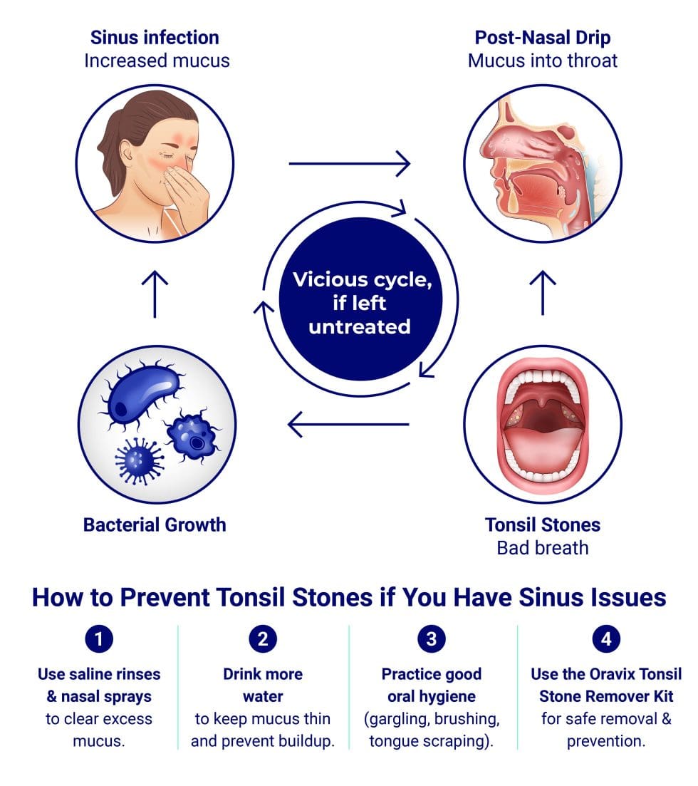 Bad breath, post-Nasal Drip, Tonsil Stones: what's the link?